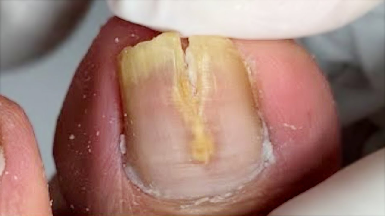 Severe Toenail Fungal Infection Treatment , Digging Out Dead Toenails ...