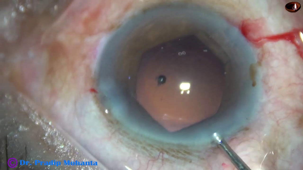 B-HEX pupil expander for managing cataract with small pupil : Pradip ...