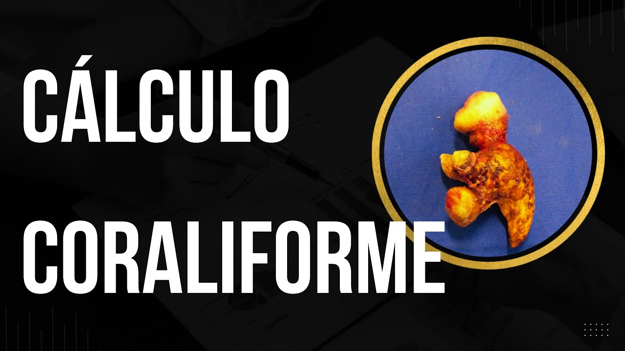 O perigoso CÁLCULO CORALIFORME - YouTube
