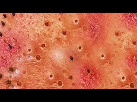 𝐑𝐞𝐥𝐚𝐱𝐢𝐧𝐠 𝐀𝐜𝐧𝐞 𝐓𝐫𝐞𝐚𝐭𝐦𝐞𝐧𝐭 & 𝐁𝐥𝐚𝐜𝐤𝐡𝐞𝐚𝐝 𝐑𝐞𝐦𝐨𝐯𝐚𝐥 𝐖𝐢𝐭𝐡 𝐉𝐚𝐧𝐢𝐞 𝐒𝐩𝐚 | 𝐀𝐜𝐧𝐞 ...