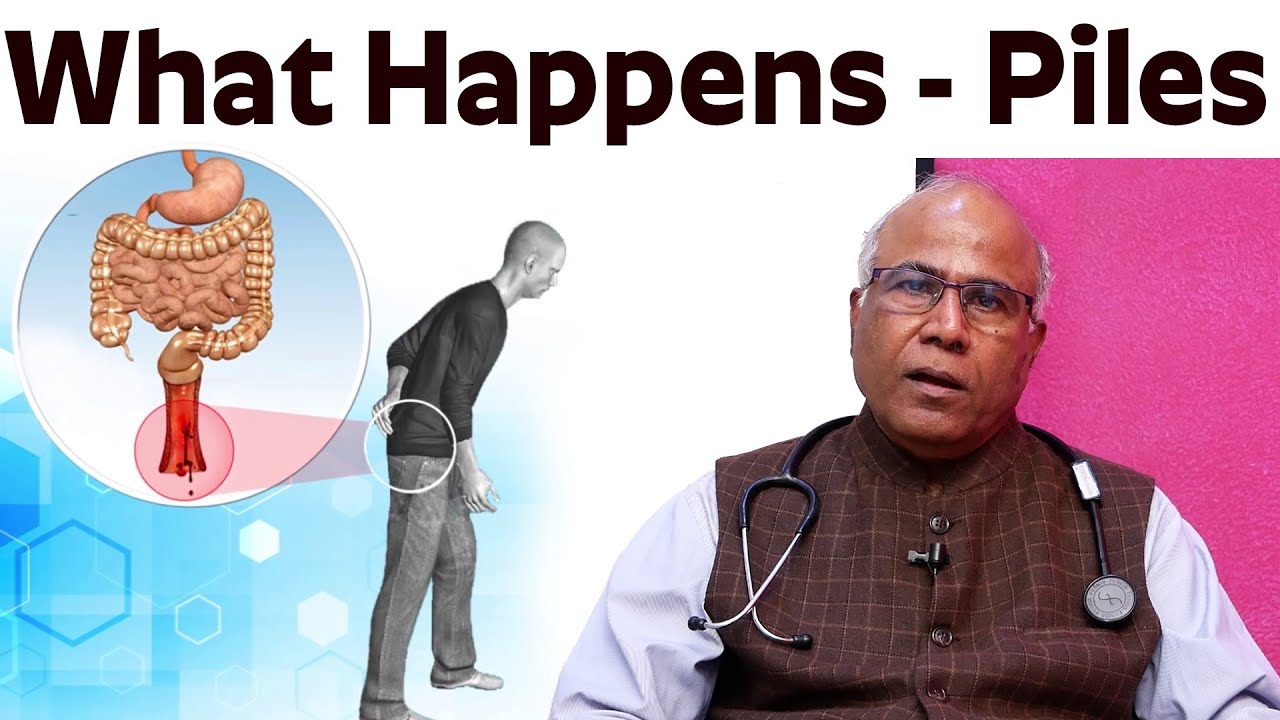 What Happens to Your Body When You Have Piles | Piles causes, and ...