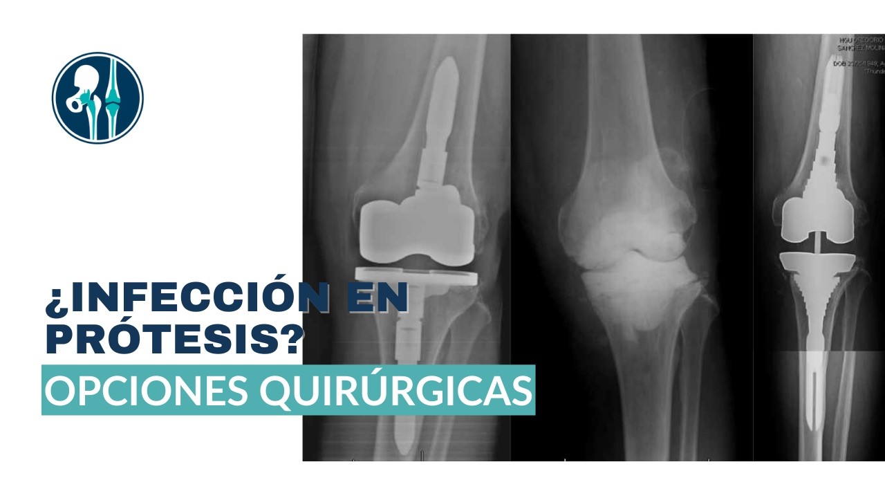 Tratamiento de Infección en Prótesis de Rodilla: Tipos y Opciones ...