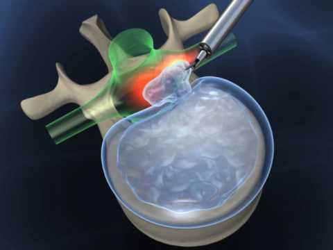 Full-endoscopic microdiscectomy for herniated disc, transforaminal ...