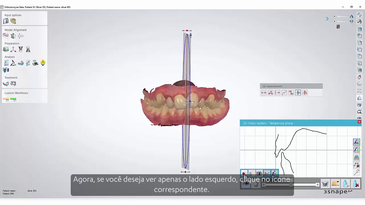 3Shape Ortho Analyzer - Como usar a ferramenta de corte transversal ...