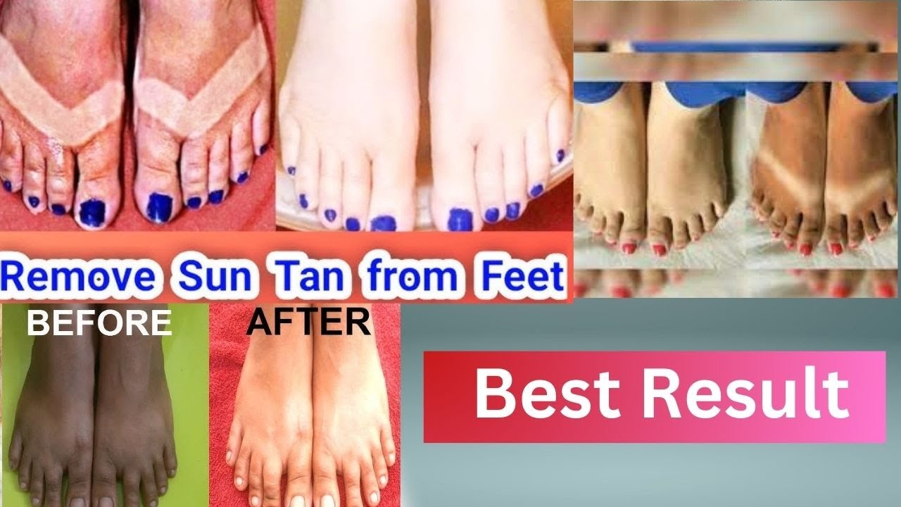Natural Remedies to Remove Sun Tan | Get Rid of Sun Tan & Keep Hand ...