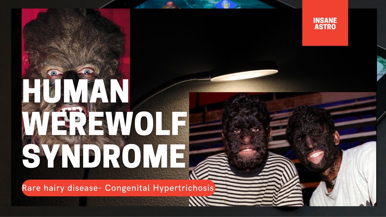 Human Werewolf Syndrome || A rare disease || A must watch video - YouTube