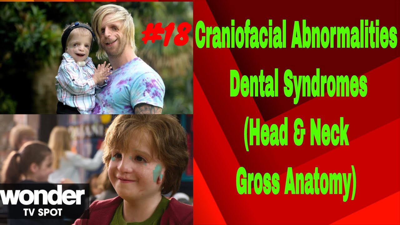 Craniofacial & Dental Syndromes (INBDE- Dental Boards) - YouTube