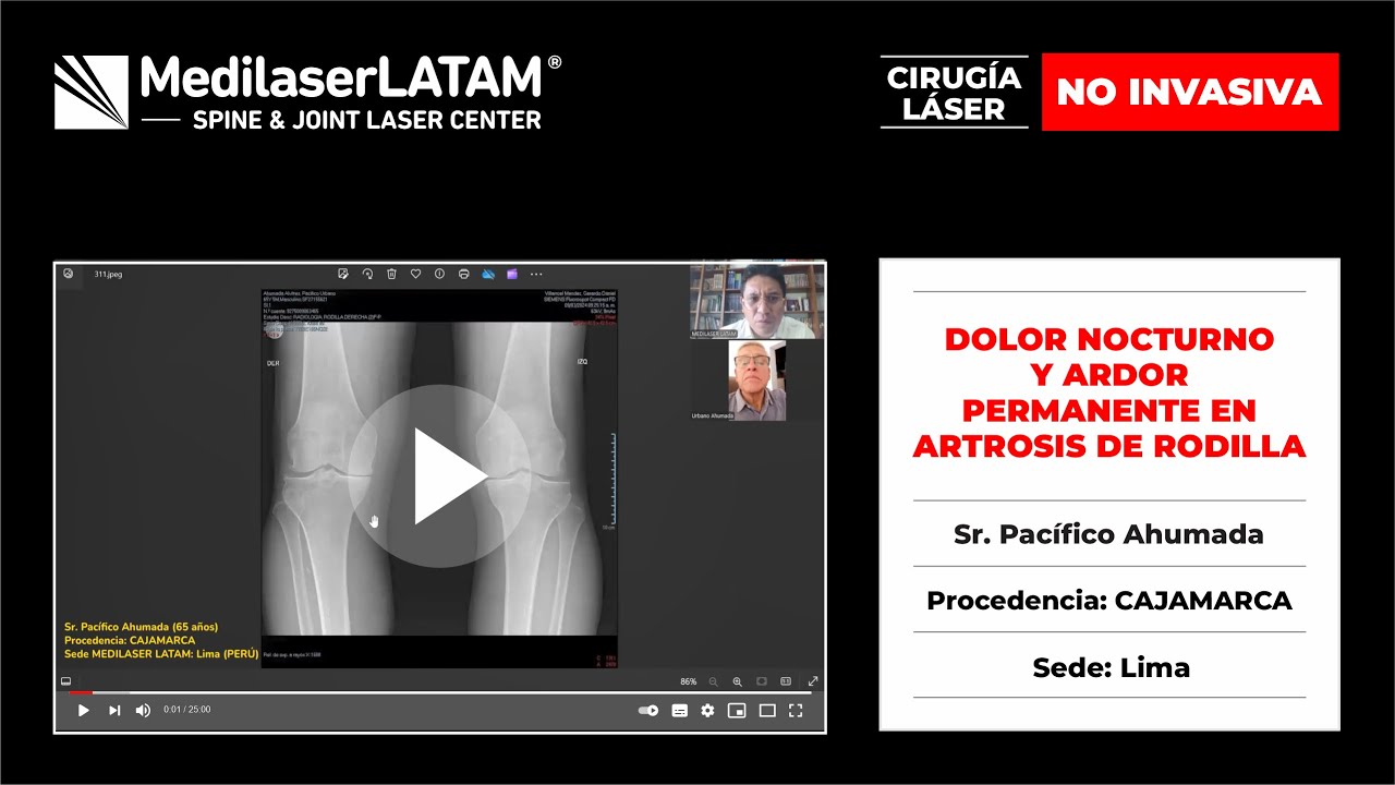TESTIMONIO: Dolor nocturno y ardor permanente en Artrosis de rodilla ...