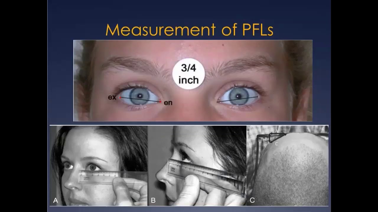 Fetal Alcohol Spectrum Disorders FASD Diagnosis and FASD Informed Care ...
