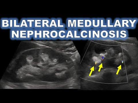 MEDULLARY NEPHROCALCINOSIS ON ULTRASOUND - YouTube