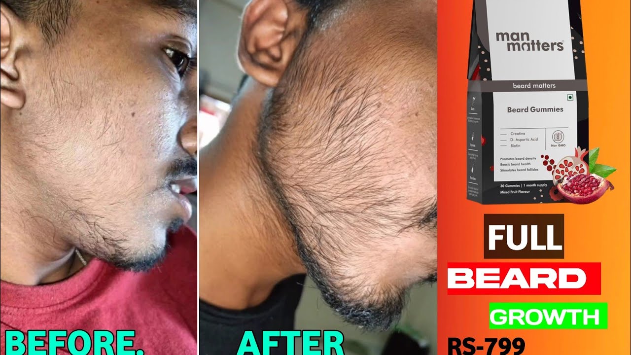 man matters beard gummies review | Man matters beard gummies result ...