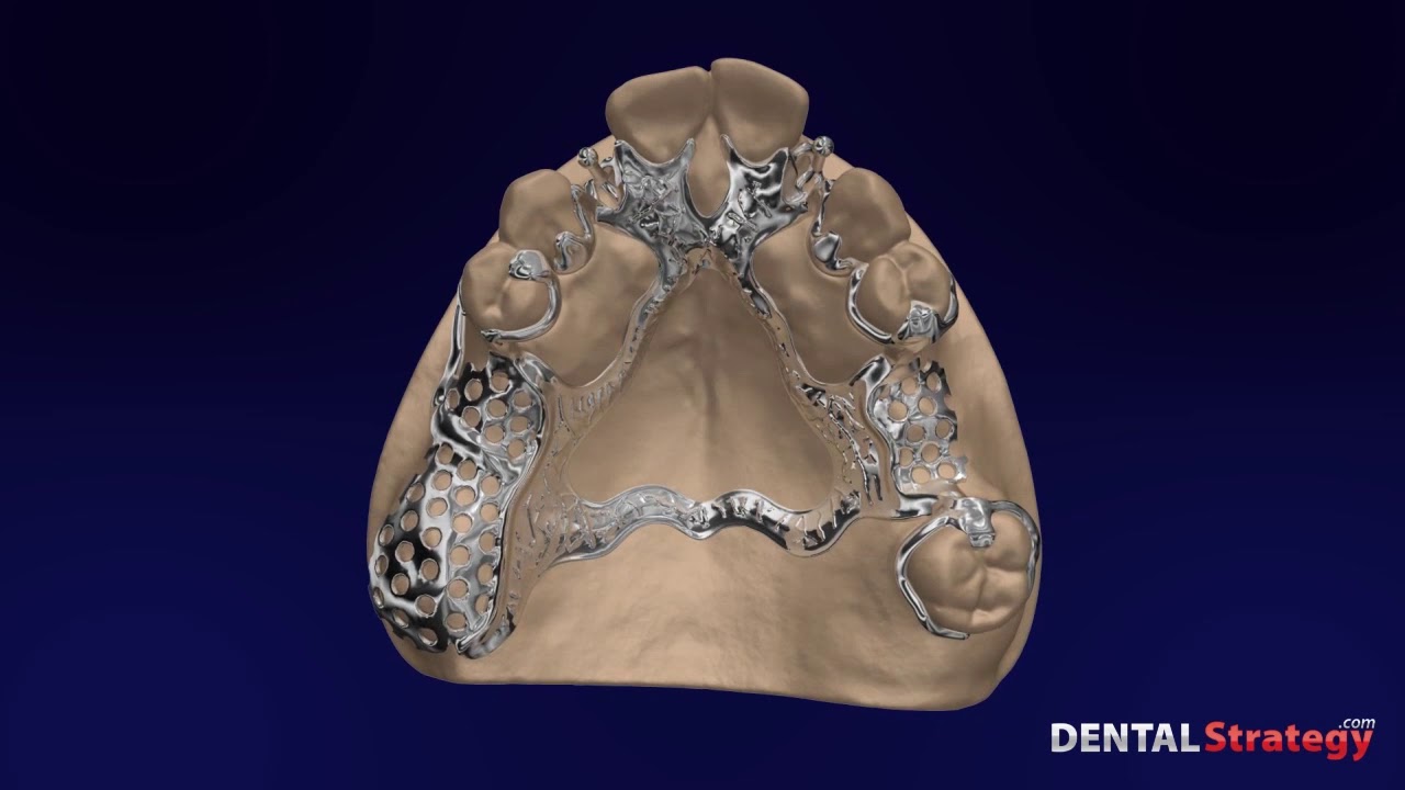 212 - Upper RPD Class II mod 3 - YouTube