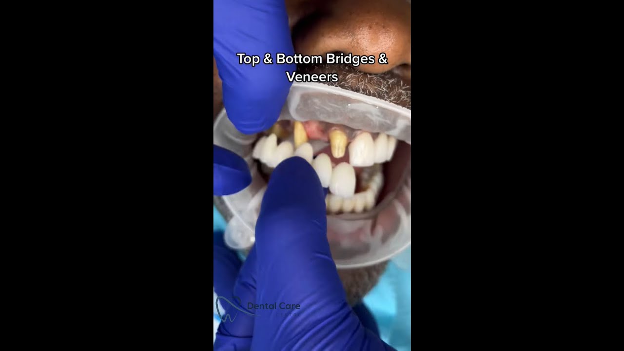 Top & Bottom Bridges and Veneers - YouTube