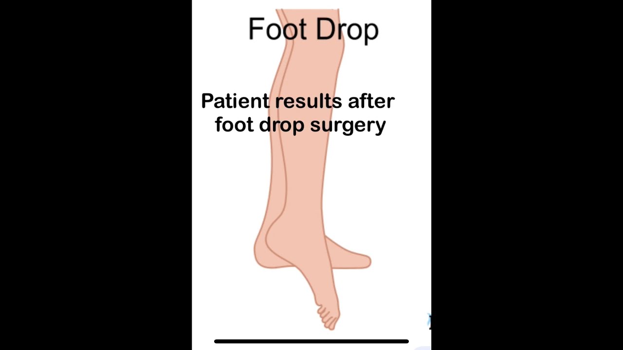 Foot drop Treatment and Patient reviews after surgery - YouTube
