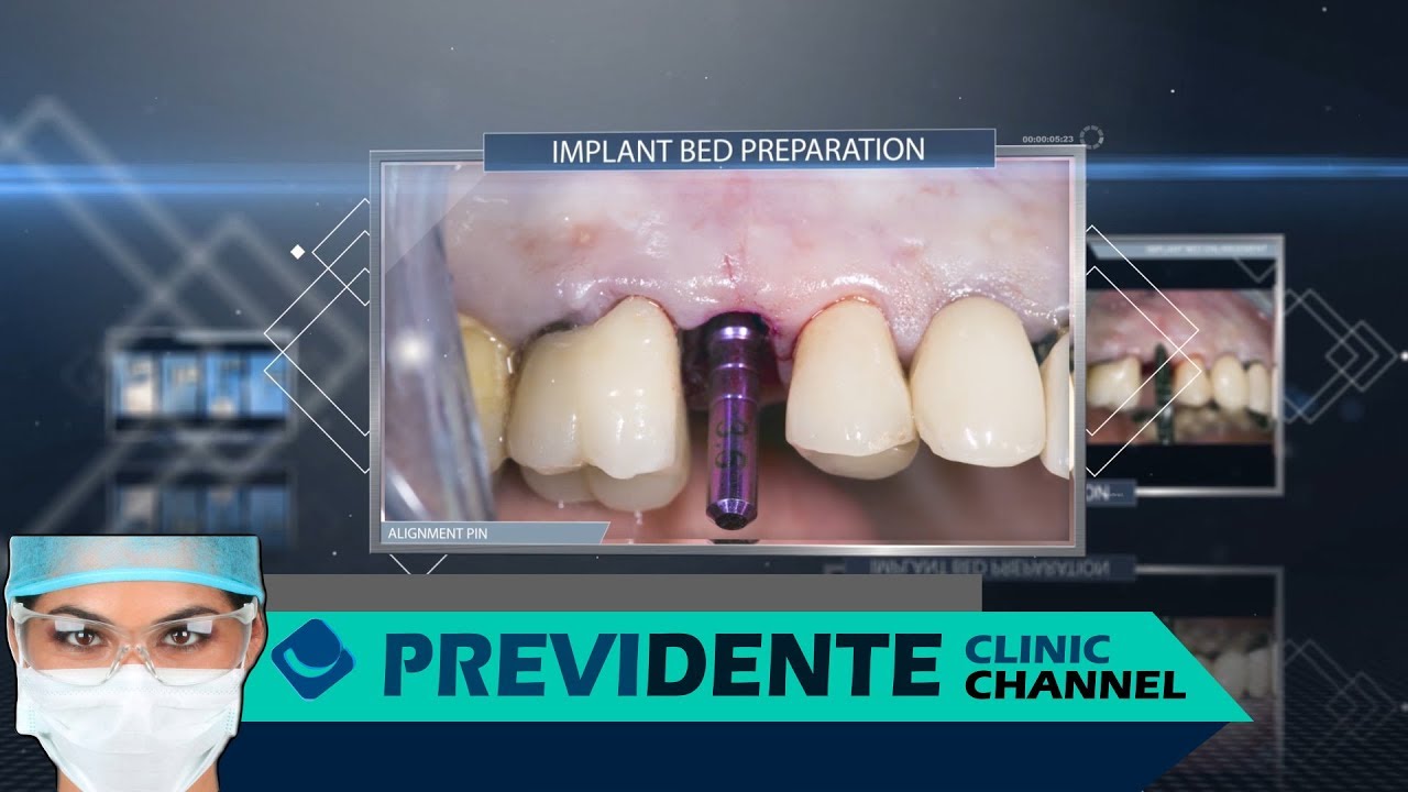 Immediate Post-Extraction Implant Placement - YouTube