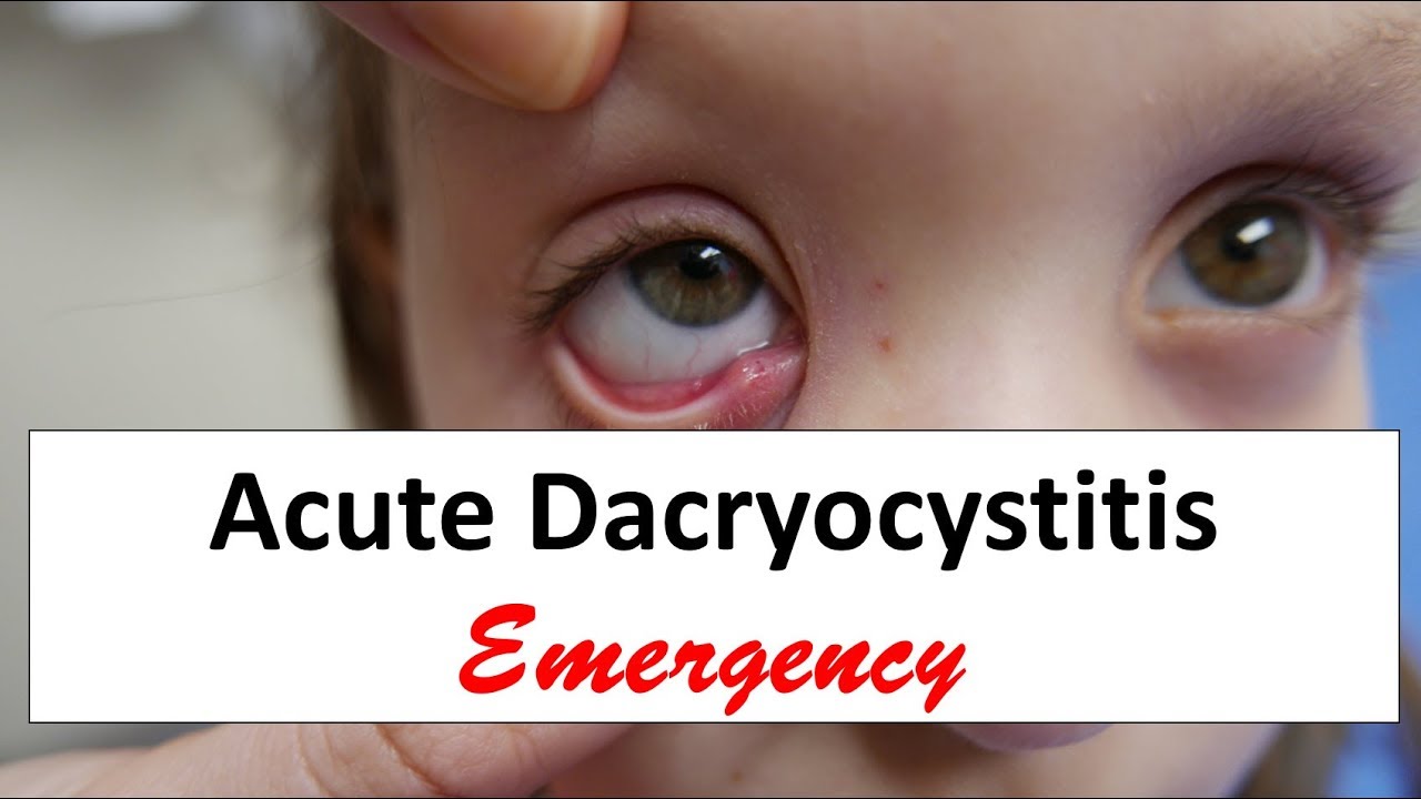 Acute Dacryocystitis Emergency - YouTube