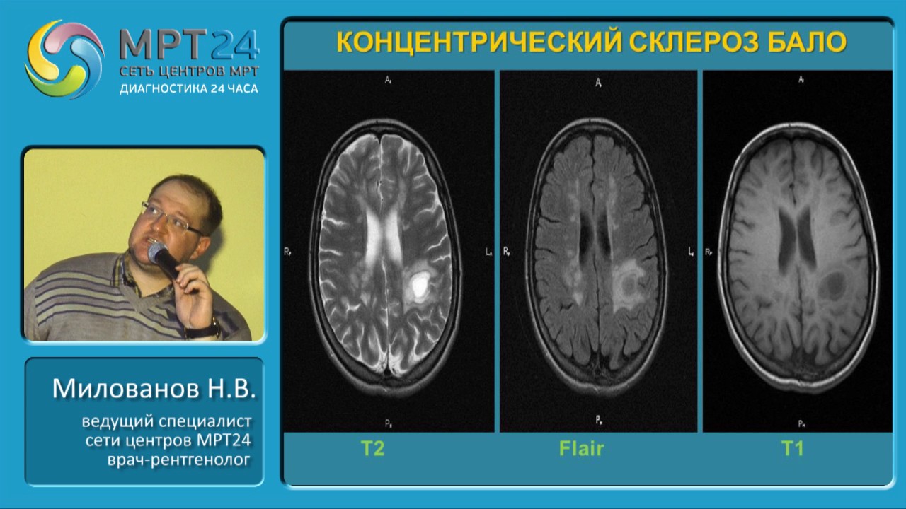 «Дифференциальная диагностика очаговых и объемных изменений головного