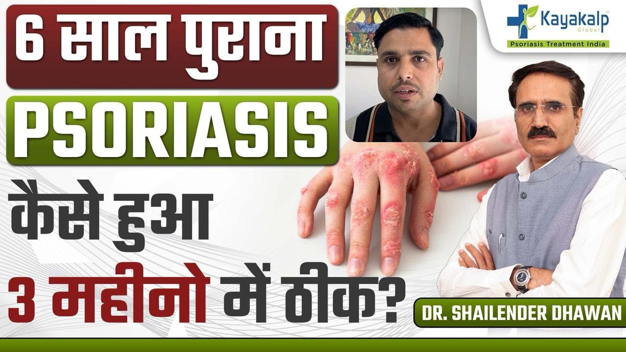 3 महीनो में हुआ 6 साल पुराना Psoriasis ठीक!! | Best Psoriasis Recovery ...