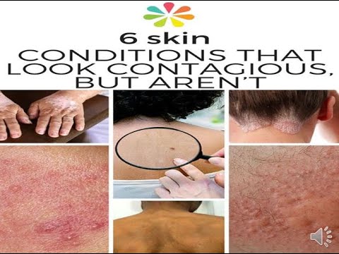 6 skin conditions that looks contagious but are not - YouTube
