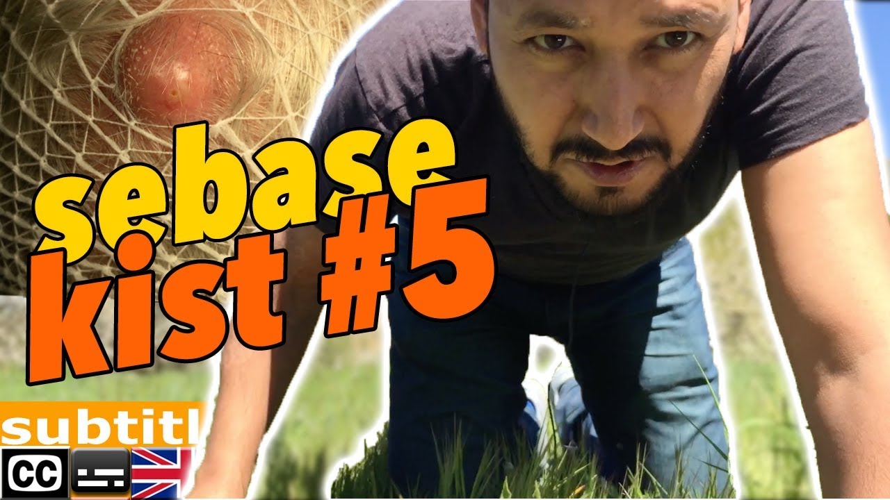SEBASE KİST PATLATMA | EXPLOSIVE SEBACEOUS CYST ON HEAD - YouTube