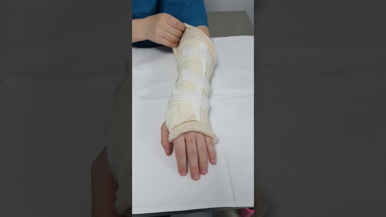 How to remove and apply a removable cast - YouTube