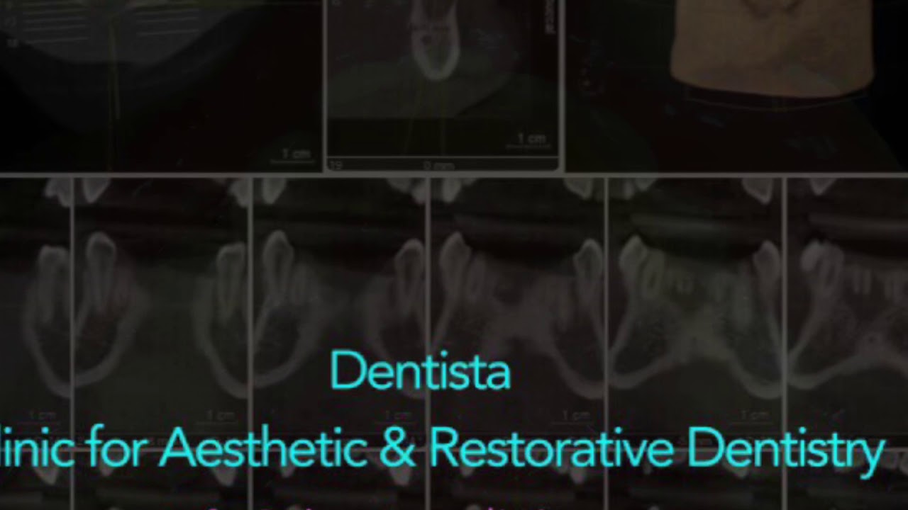 Management of Infected Radicular Cyst - YouTube