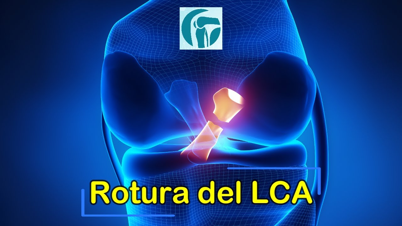 Típica Lesión Deportiva De Rodilla: Rotura Del Ligamento Cruzado ...