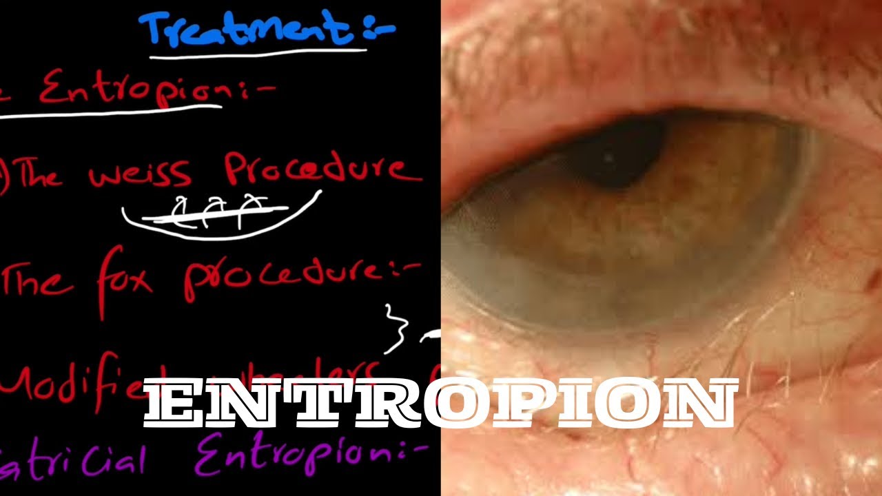 What is Entropion ? And it’s types , signs and symptoms , and treatment ...