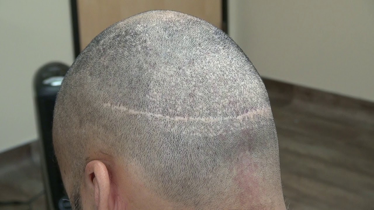 Dr. Diep Hair Transplant Scar FUT Linear From Surgery Bald Hair Loss ...