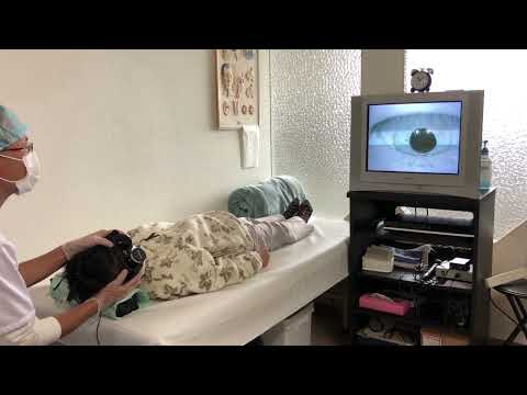 Cupulolithiasis of right posterior semicircular canal - YouTube