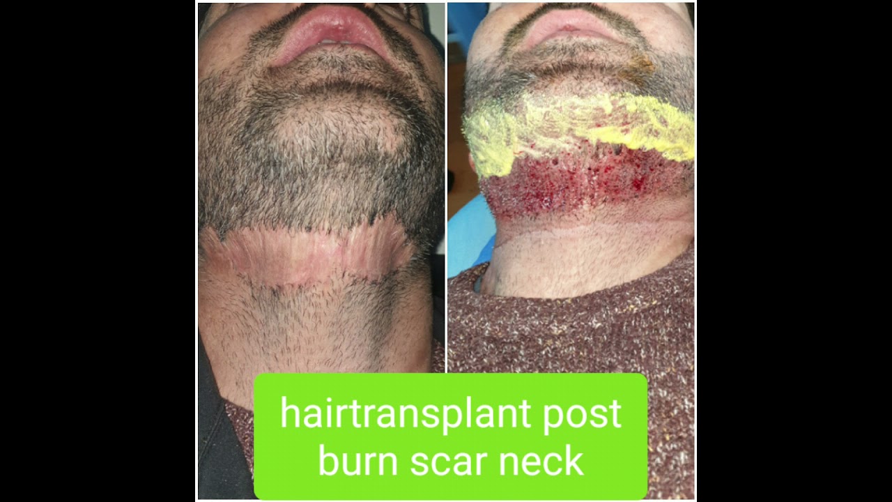 Beard hair transplant on post burn scar neck - YouTube