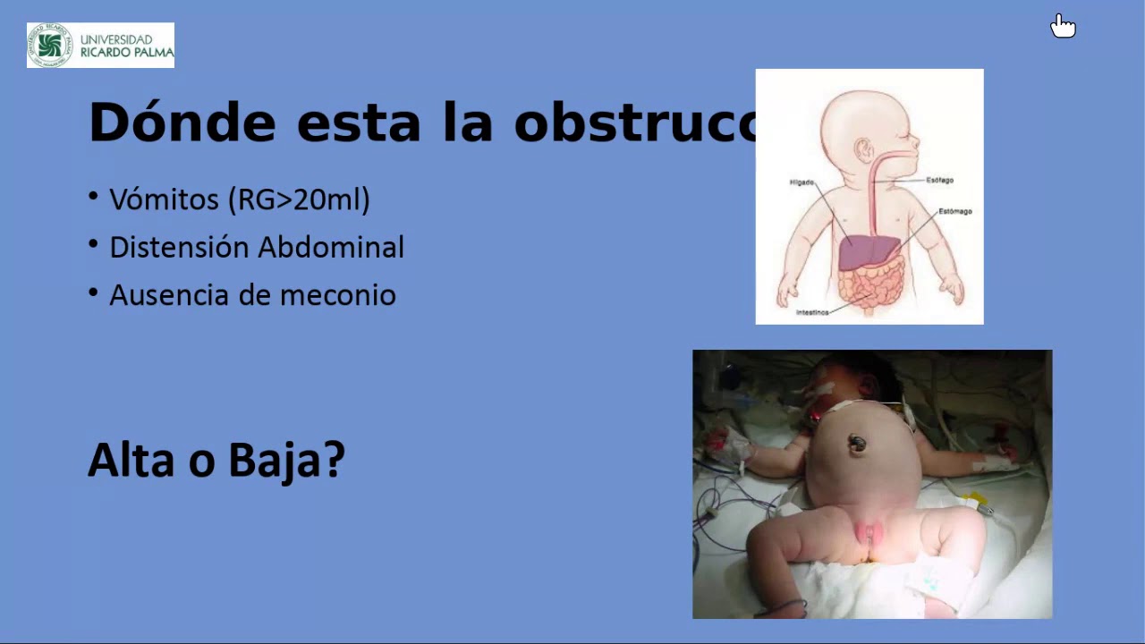 2. Atresia y estenosis intestinales: atresia y estenosis duodenales ...