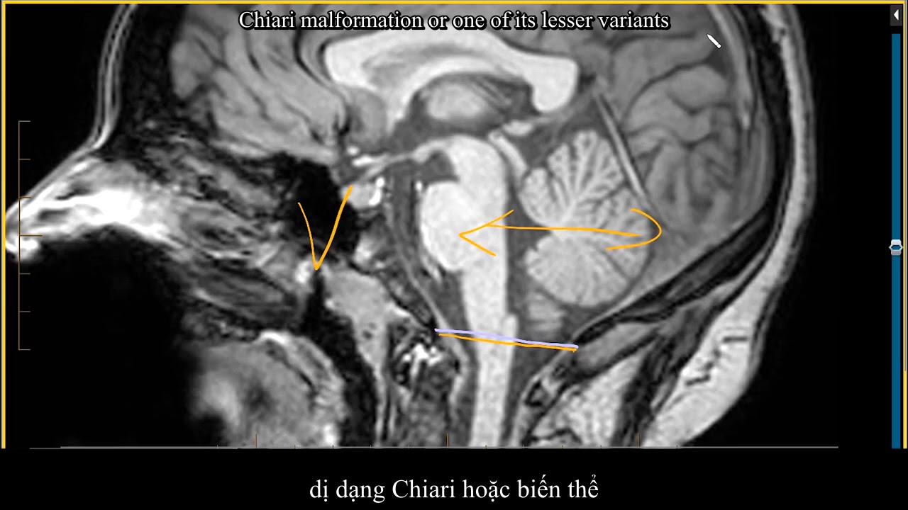 15. Giải phẫu MRI sọ não: Midline Cerebellum Vermis - YouTube