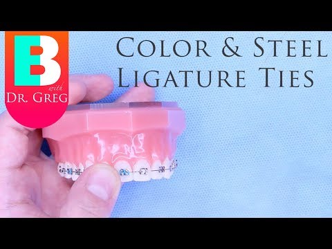 What Is A Ligature In Orthodontics