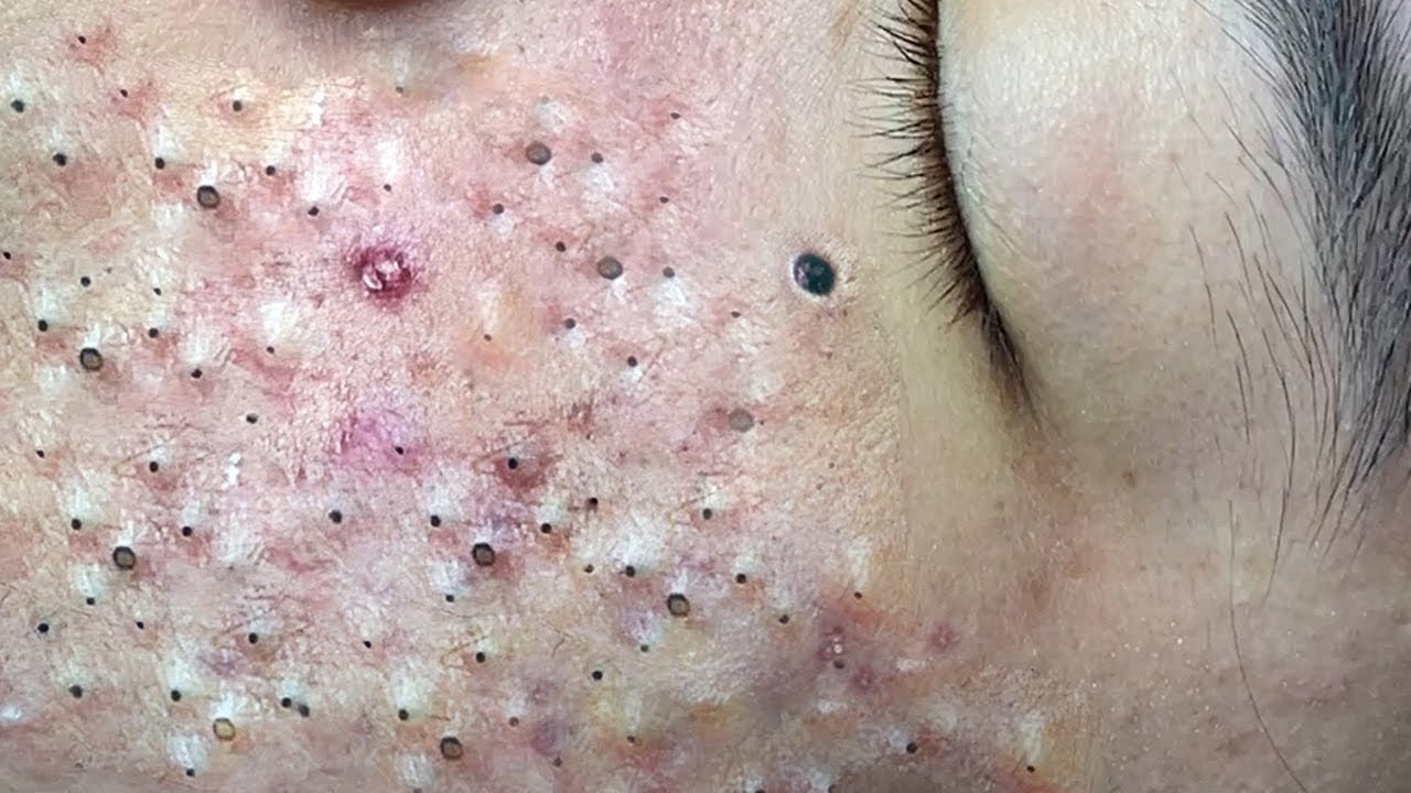 acne blackheads whiteheads removal Day 7909 - YouTube