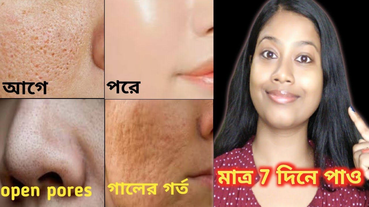 7 দিনে মুখের গর্ত মেছেদার দাগ ব্রণের দাগ দূর করার উপায় How To