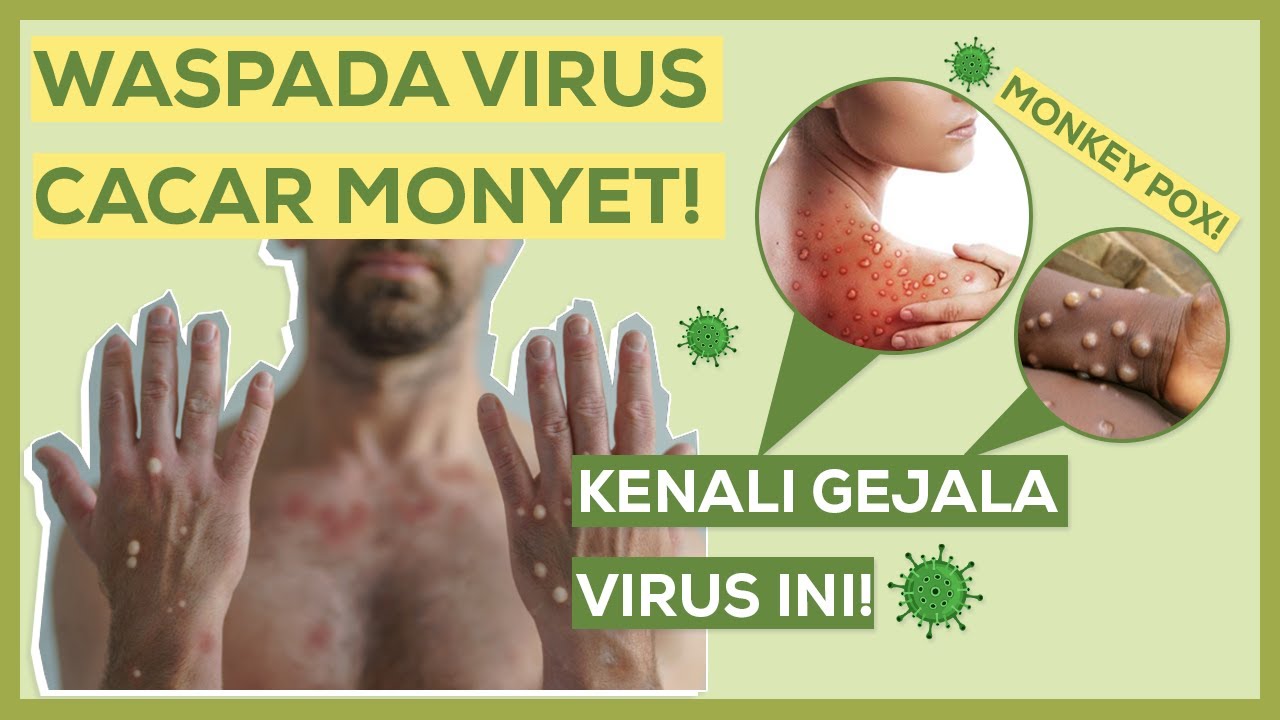 Wabah Monkeypox Semakin Meluas! Kenali Gejala dan Pencegahan Virus ...