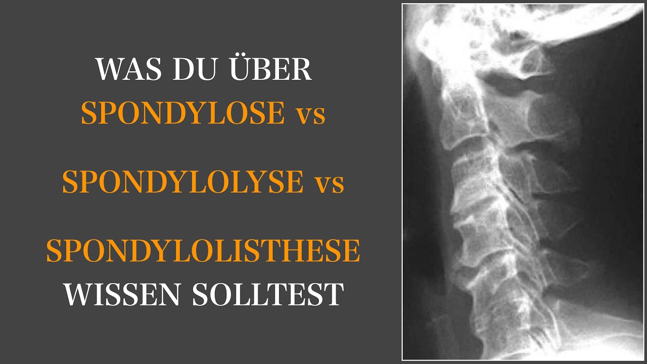Spodylose vs Spondylolyse vs Spondylolisthese I Spine I Neuroradiolgie ...