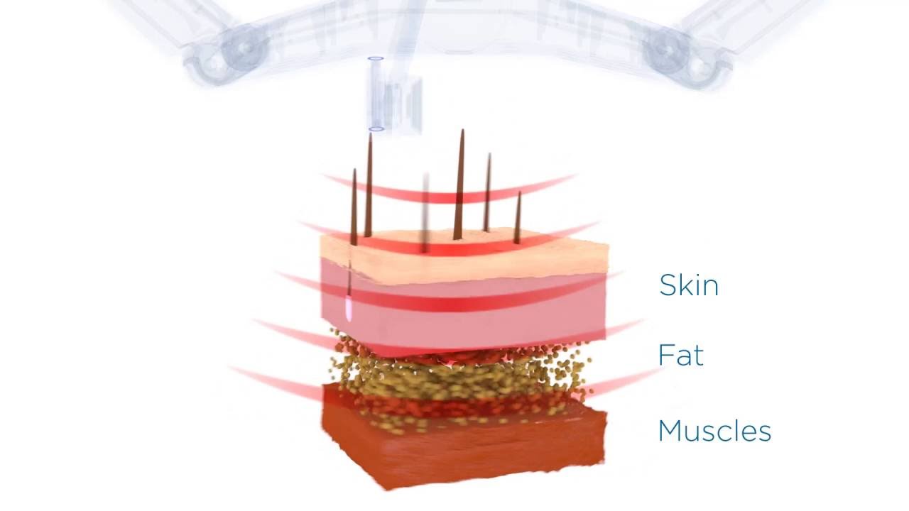 BTL Vanquish ME - Technology Made For Results - YouTube