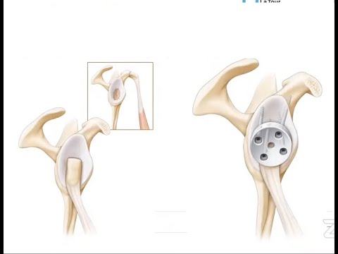 Glenoid Reconstruction Options in Shoulder Arthroplasty - YouTube