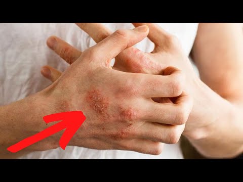 Bədəninizdə Qaşıntı Varsa Mütləq baxın!