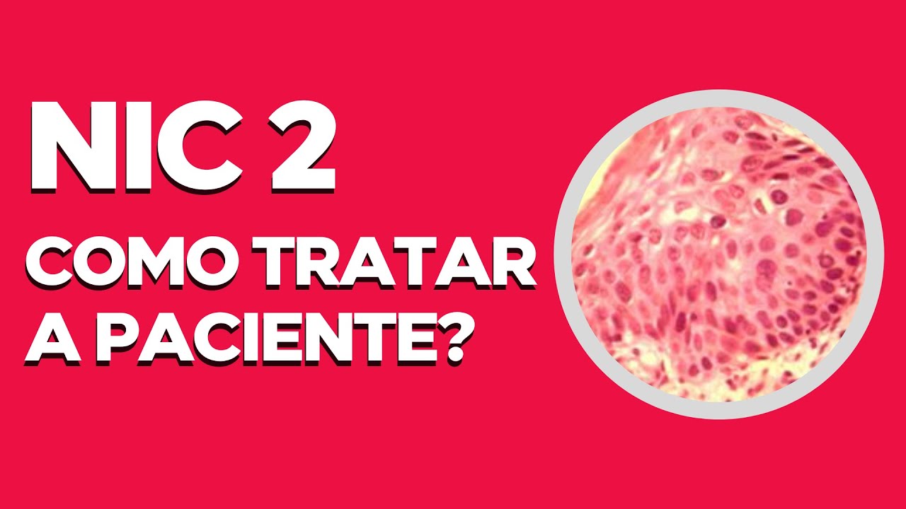 Como tratar a paciente com NIC 2? - YouTube