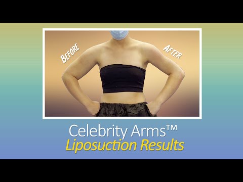 Arm Liposuction | Lipo 360° Celebrity Arms™ Liposuction | Immediate ...