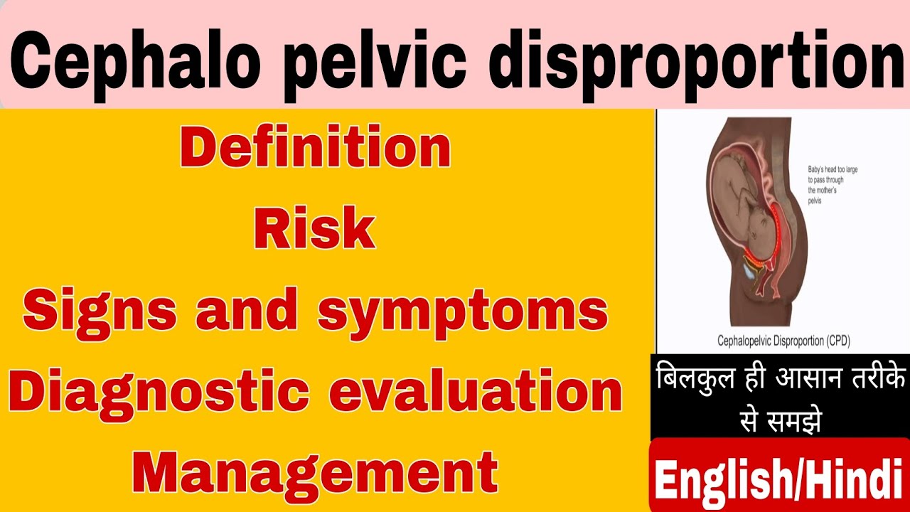 Understanding Cephalopelvic Disproportion : Definition|| Causes || S/S ...