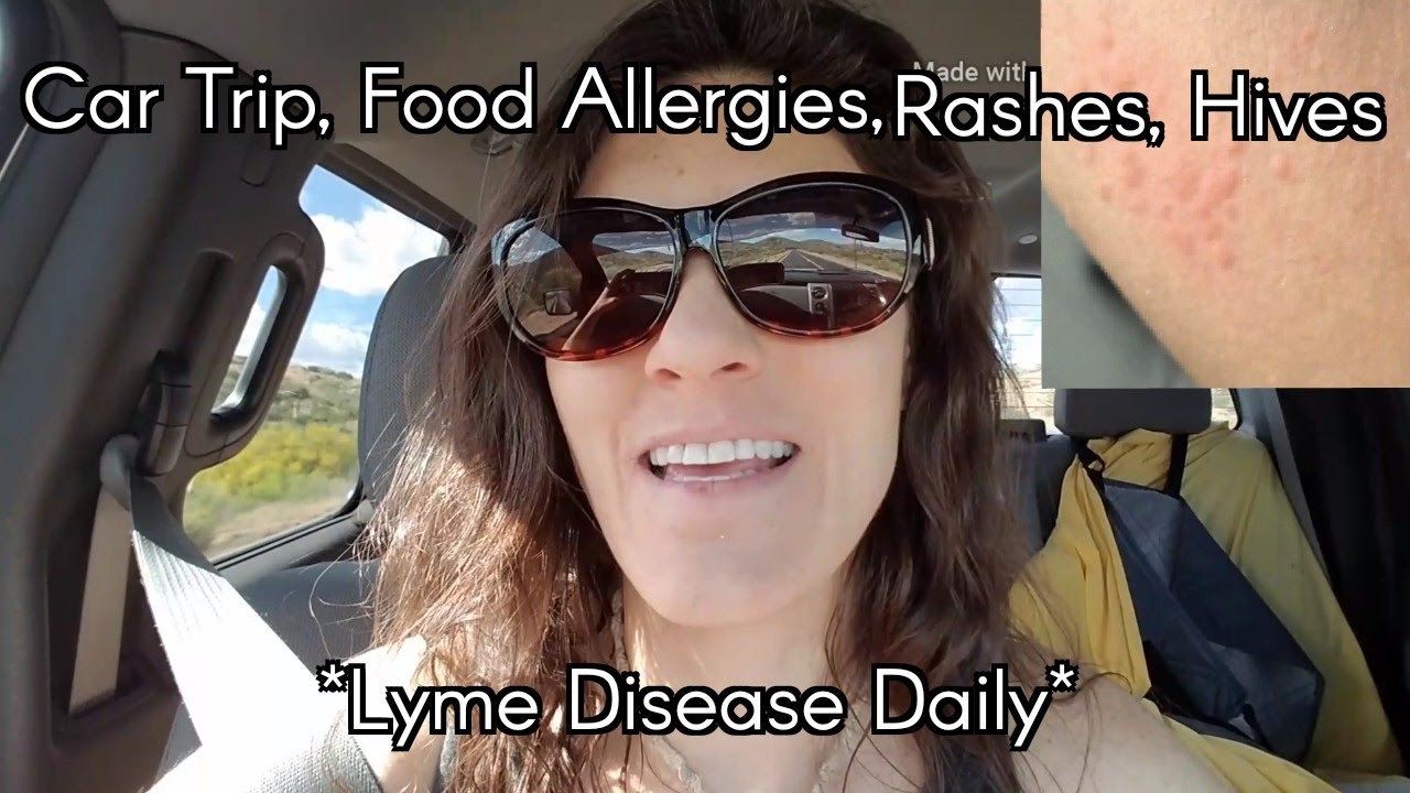 Food Allergies, Hives, & Rashes -Due to- Die Off, Detox, and Stress ...