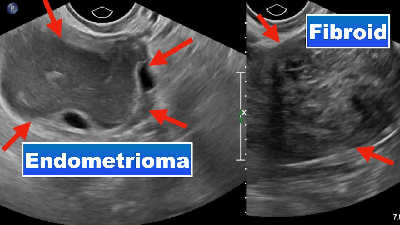 Endometrioma and fibroid uterus I Ultrasound - YouTube