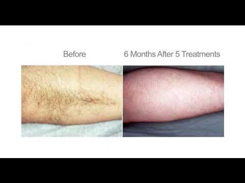 Diolaze XL Laser Hair Removal by InMode at Skin Heaven Aesthetics & Wellness (Animation) - YouTube