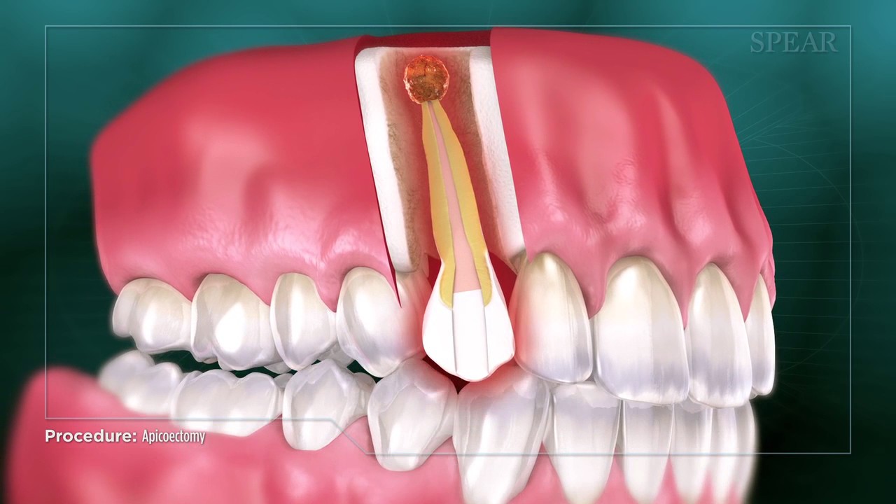 Apicoectomy.flv - YouTube