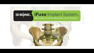 Si Joint Dysfunction And Ifuse Torq Implant Animation Full Version Si ...