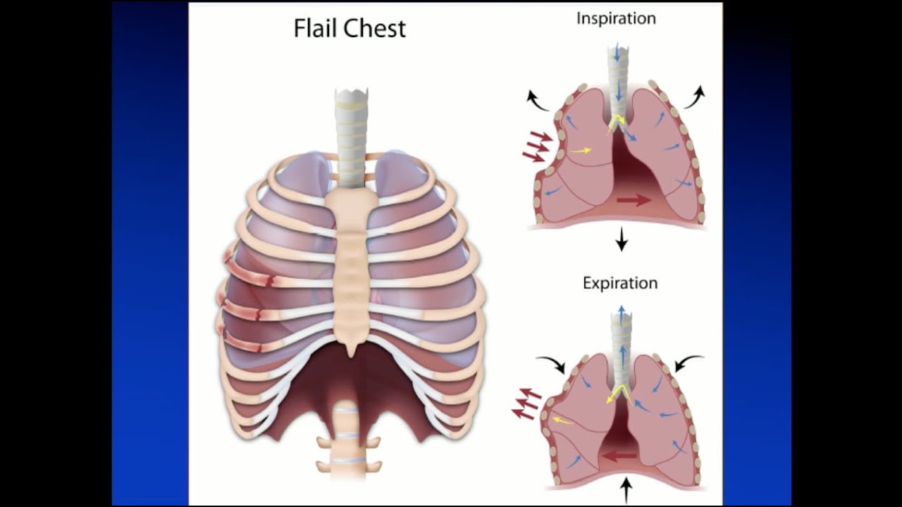Chest Wall Fixation: Lunatic Fringe Or State Of The Art - Niloofar ...